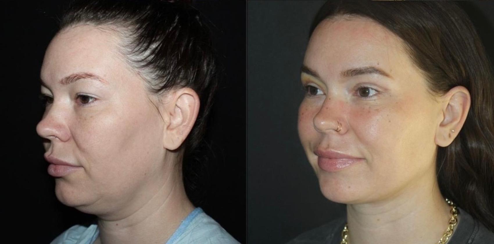 Submental Liposuction Before and After Pictures Case 127 – Charleston ...